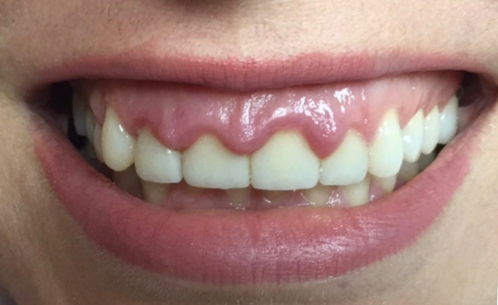 Gummy Smiles - Laser Trimming Dentist Coral Gables 33134 - Dental ...